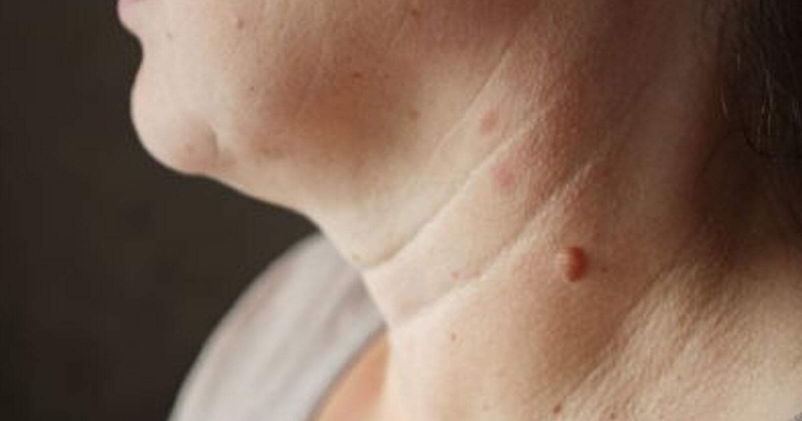 كيف يمكن إزالة الثآليل التي تظهر في مرحلة الشيخوخة؟ – وطن. يغرد خارج السرب